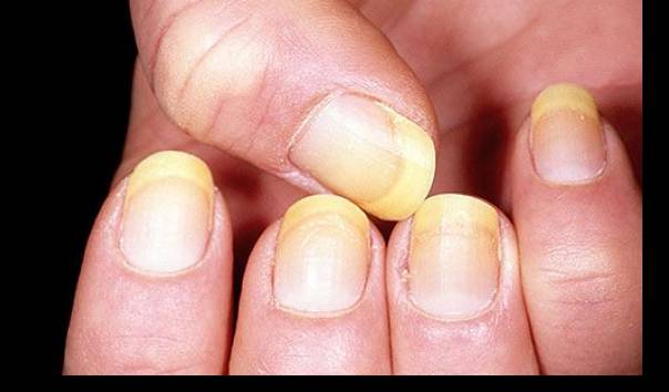 Ternyata dari Warna Kuku Bisa Deteksi Adanya Penyakit, Ini yang Paling Berbahaya