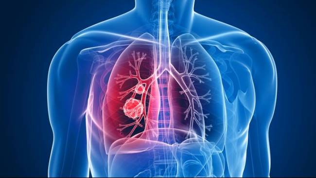 Mengenal Paru-Paru Popcorn, Penyakit Langka Akibat Paparan Diasetil